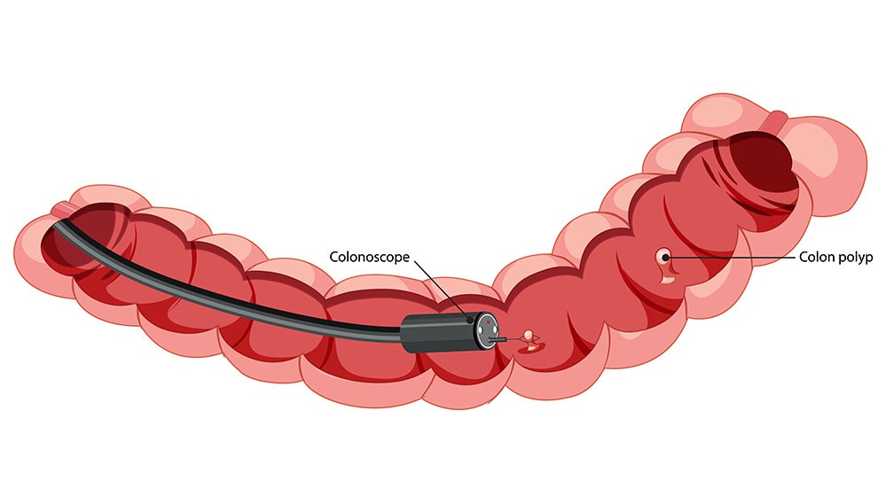 Is It Time For A Colonoscopy Inova Newsroom
